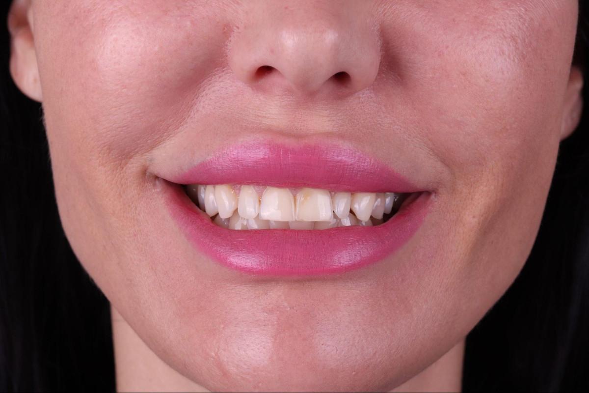 What Effect Do Braces Have on Facial Structure?