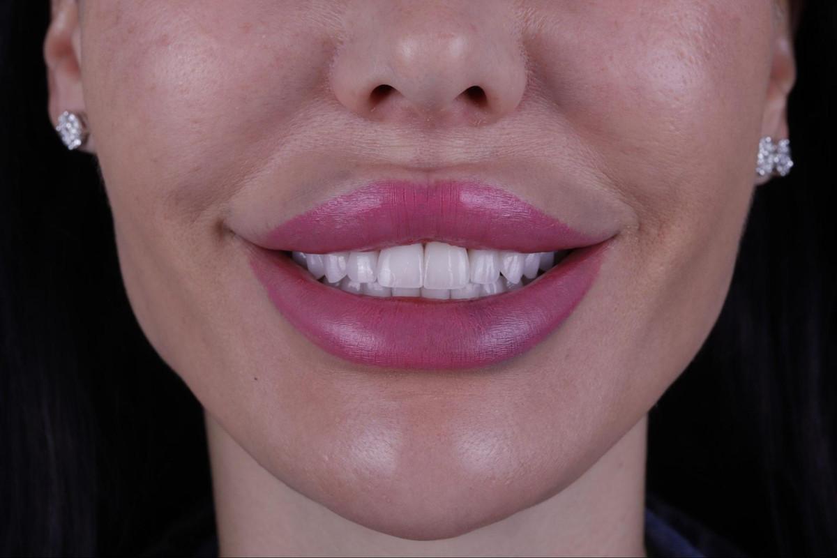 What Effect Do Braces Have on Facial Structure?
